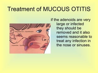 Otitis part 3 | PPT