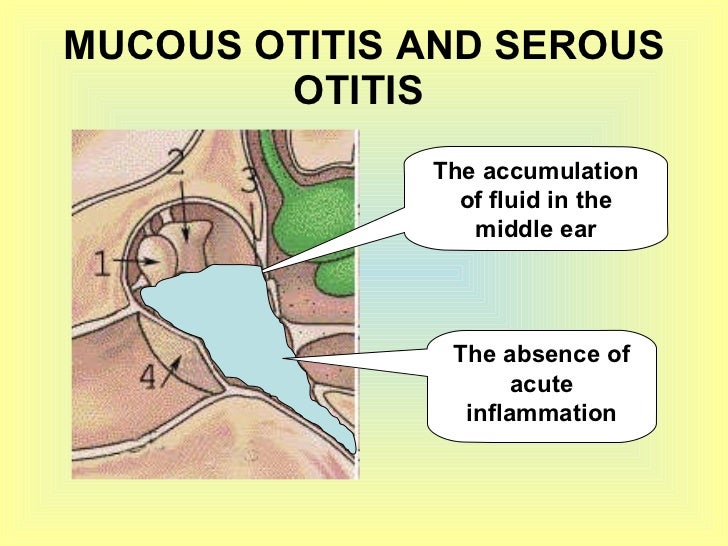 Otitis part 3