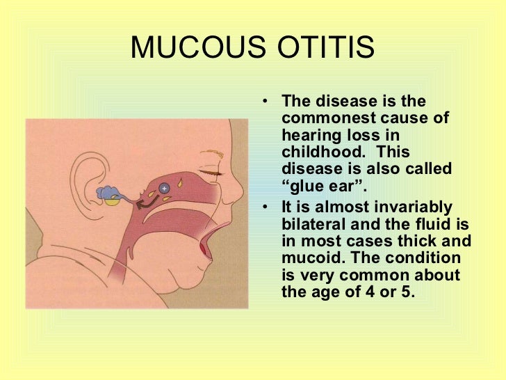 Otitis part 3