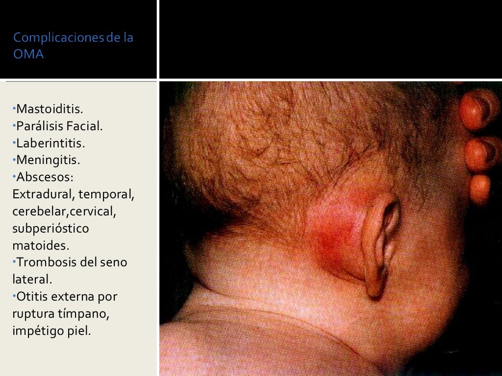 Otitis Media Aguda