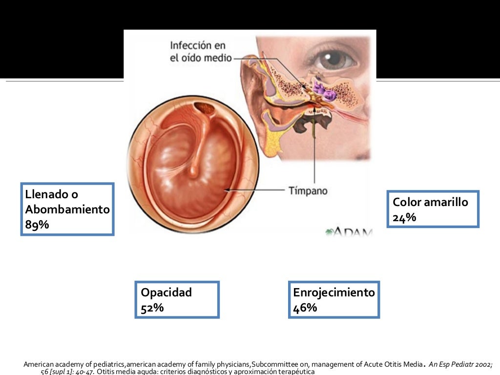 Otitis Media Aguda