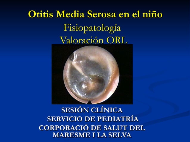 Otitis Media Serosa En El NiñO 2008 | PPT