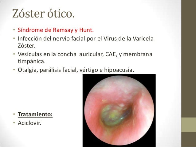 Otitis externa