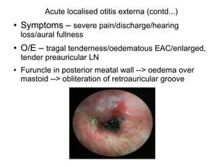 Otitisexterna BY DR MUHAMMAD USMAN GHANI (KSMC ) | ODP