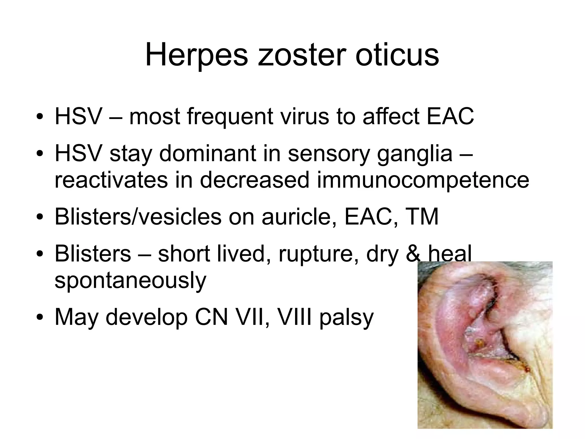 Otitis externa | ODP