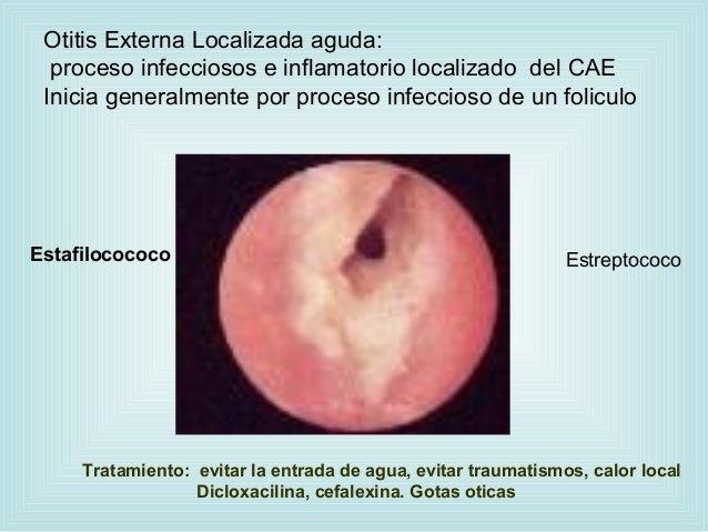 Otitis externa