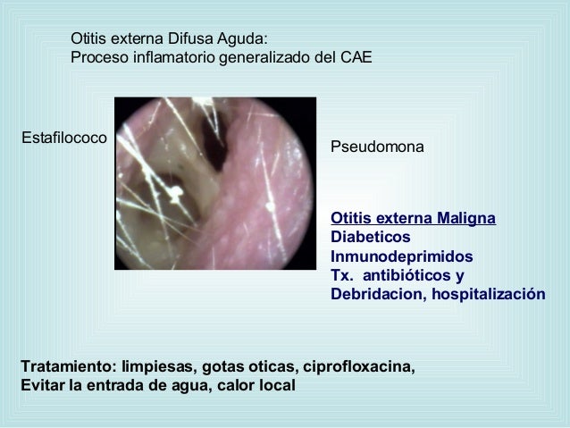 Otitis Media