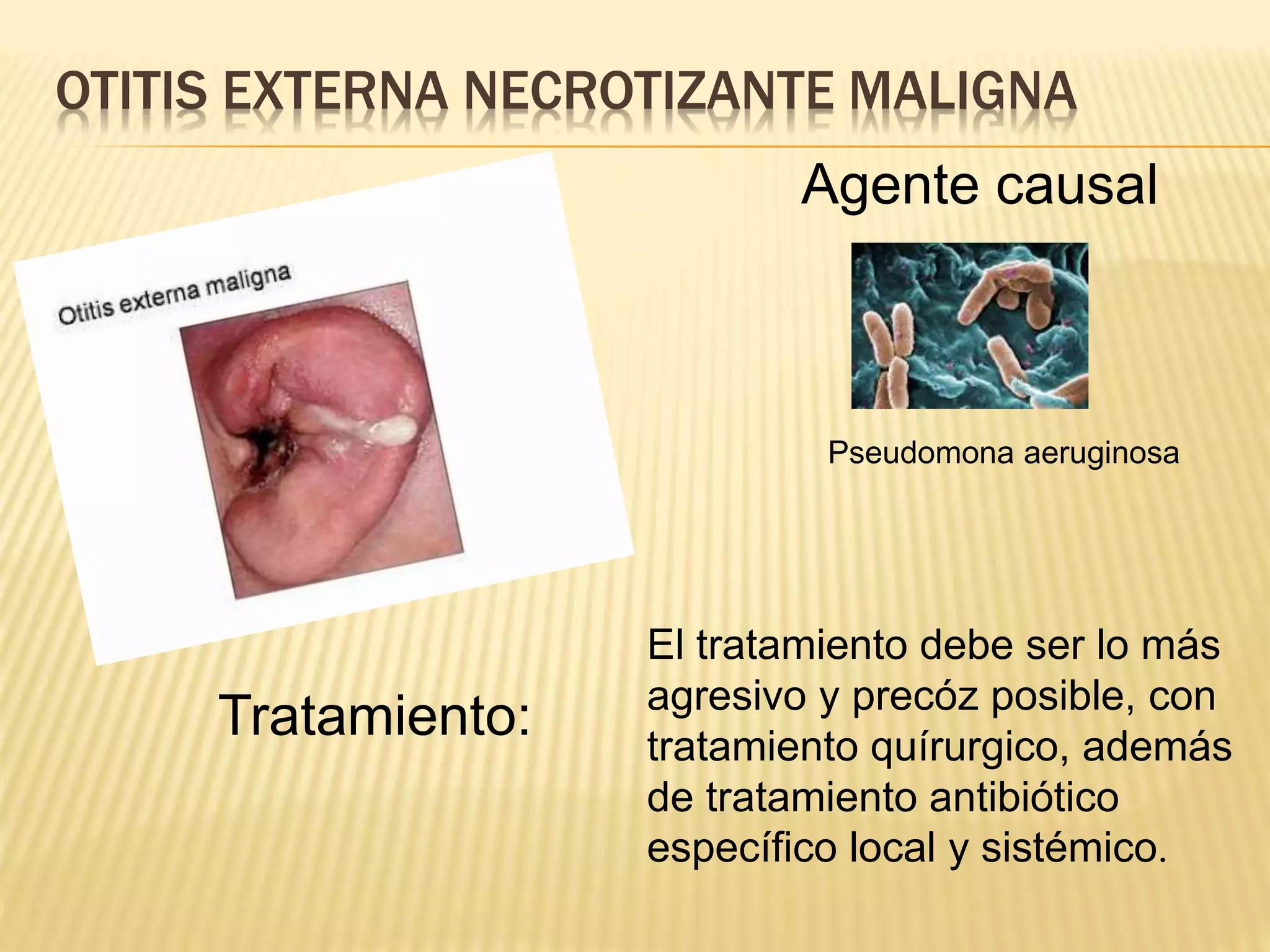 Otitis externa | PPT