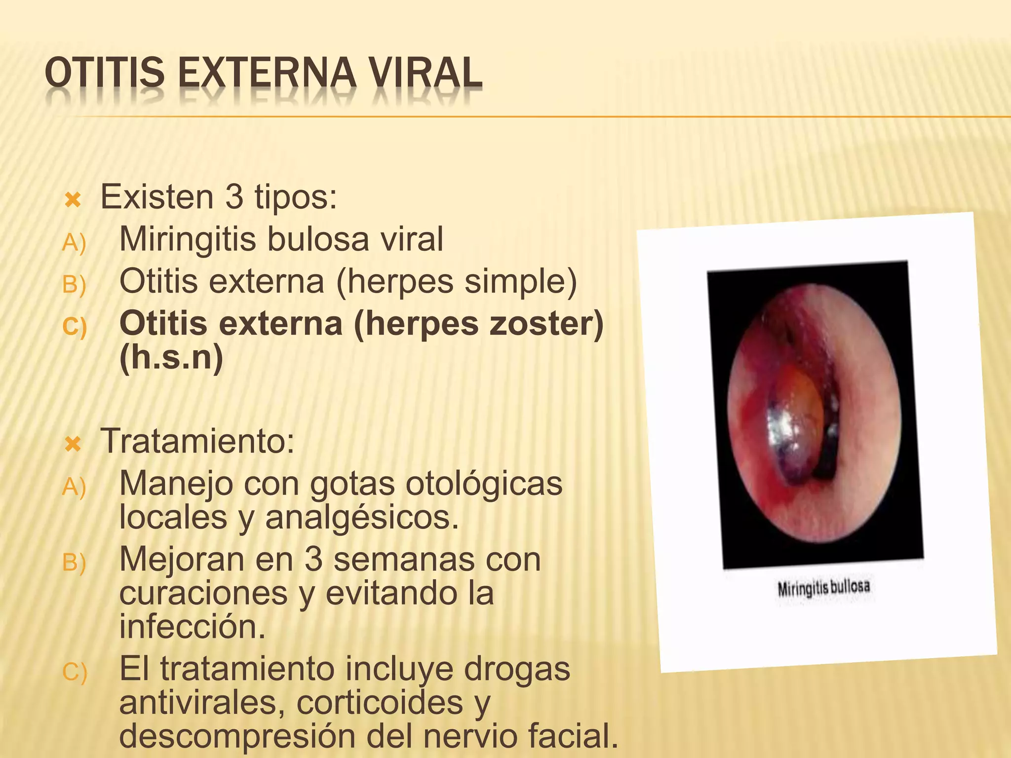 Otitis externa | PPTX