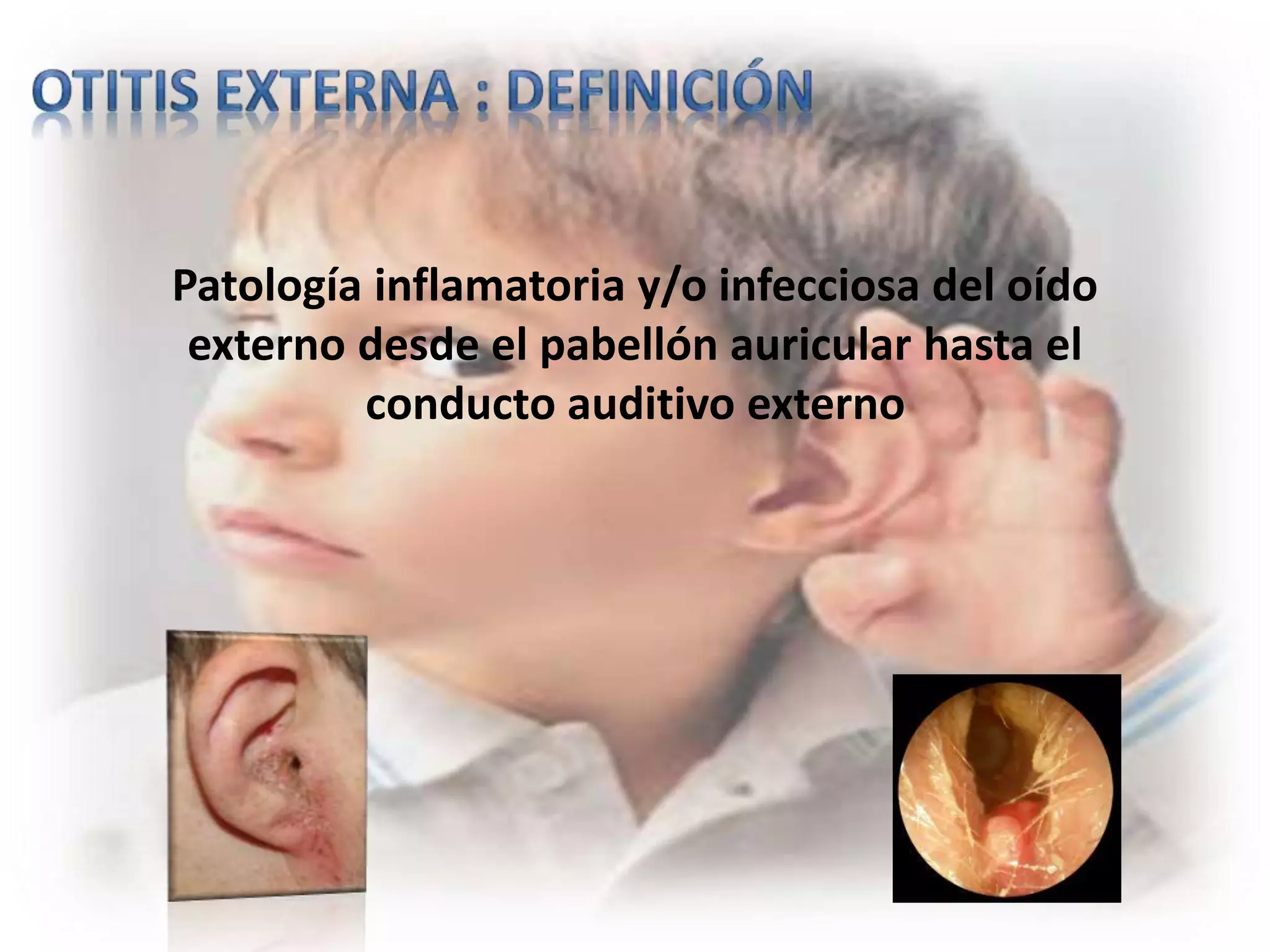 Otitis externa | PPTX | Ear, Nose and Throat Conditions | Diseases and ...
