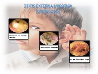 Otitis externa | PPTX | Ear, Nose and Throat Conditions | Diseases and ...
