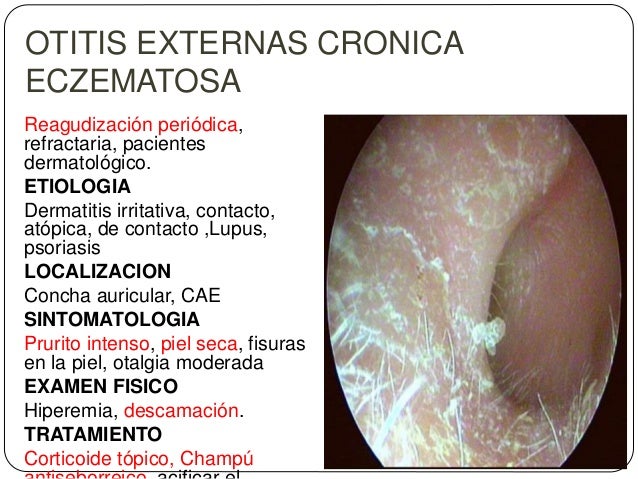 Otitis externa