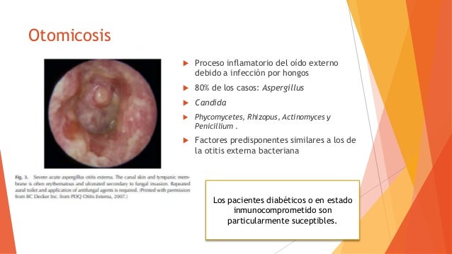 Otitis externa