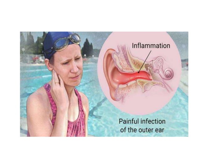 Otitis externa | PPTX | Ear, Nose and Throat Conditions | Diseases and ...