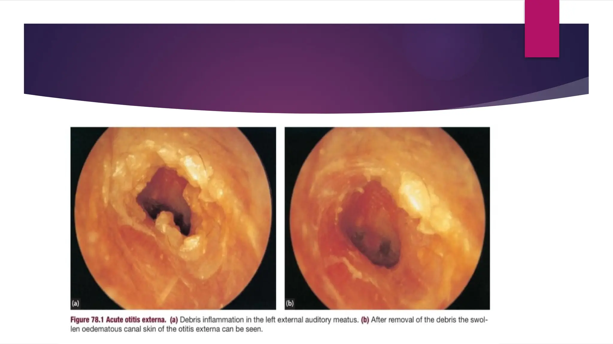 Otitis Externa ear PowerPoint presentation | PPTX
