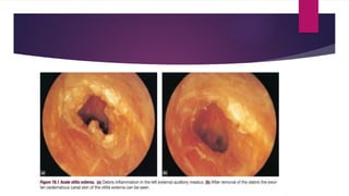 Otitis Externa ear PowerPoint presentation | PPTX