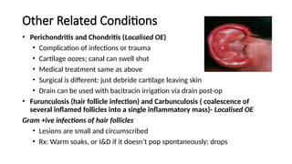 Otitis Externa.pptx1234556666777543334677 | PPTX