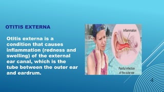 OTITIS EXTERNA | PPTX
