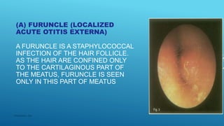 OTITIS EXTERNA | PPTX