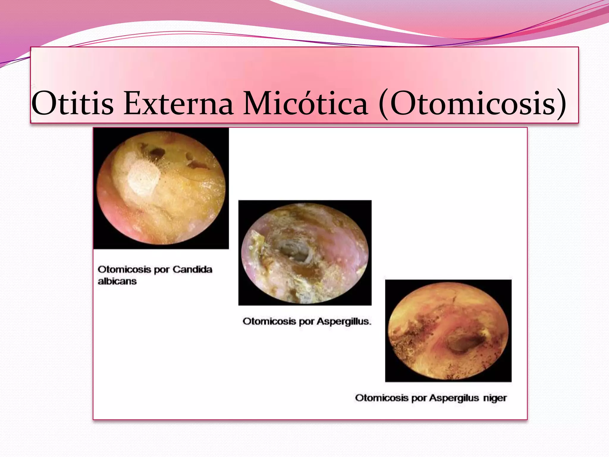Otitis externa | PPTX
