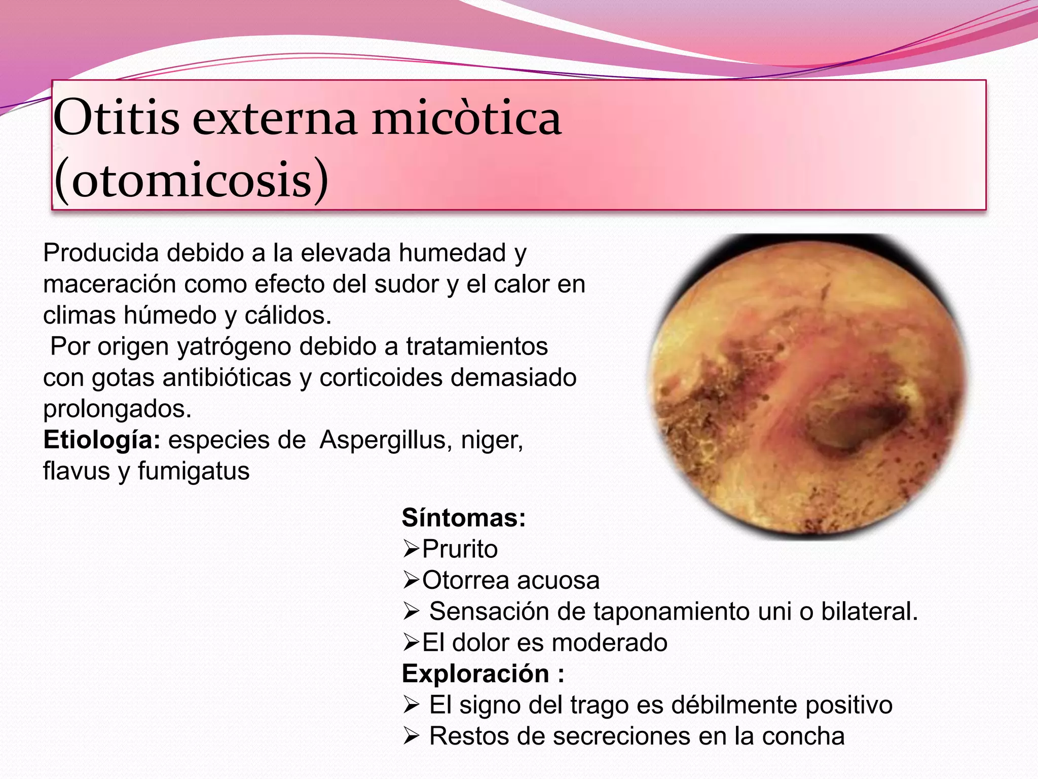 Otitis externa | PPTX