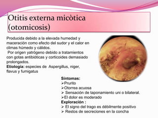 Otitis externa | PPT