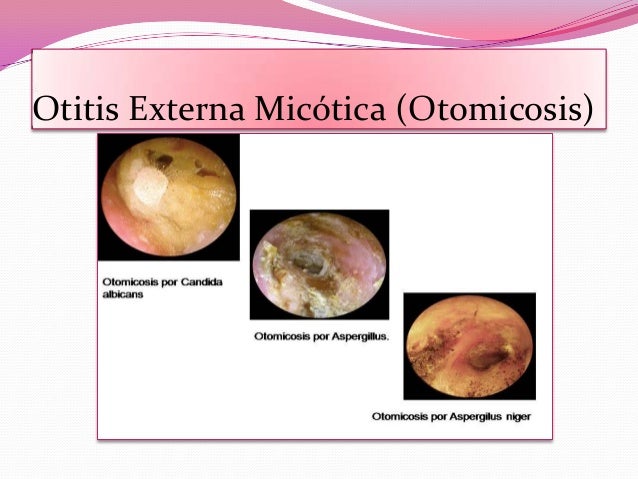 Otitis externa