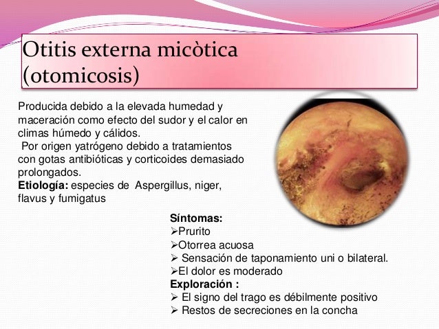 Otitis externa