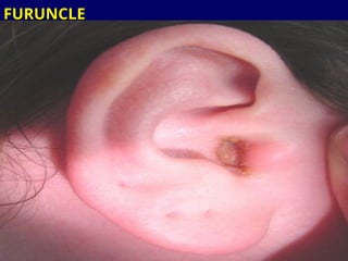 Otitis Externa(1).ppt 111111111111111111 | PPT