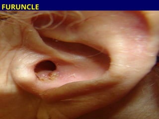 Otitis Externa(1).ppt 111111111111111111 | PPT
