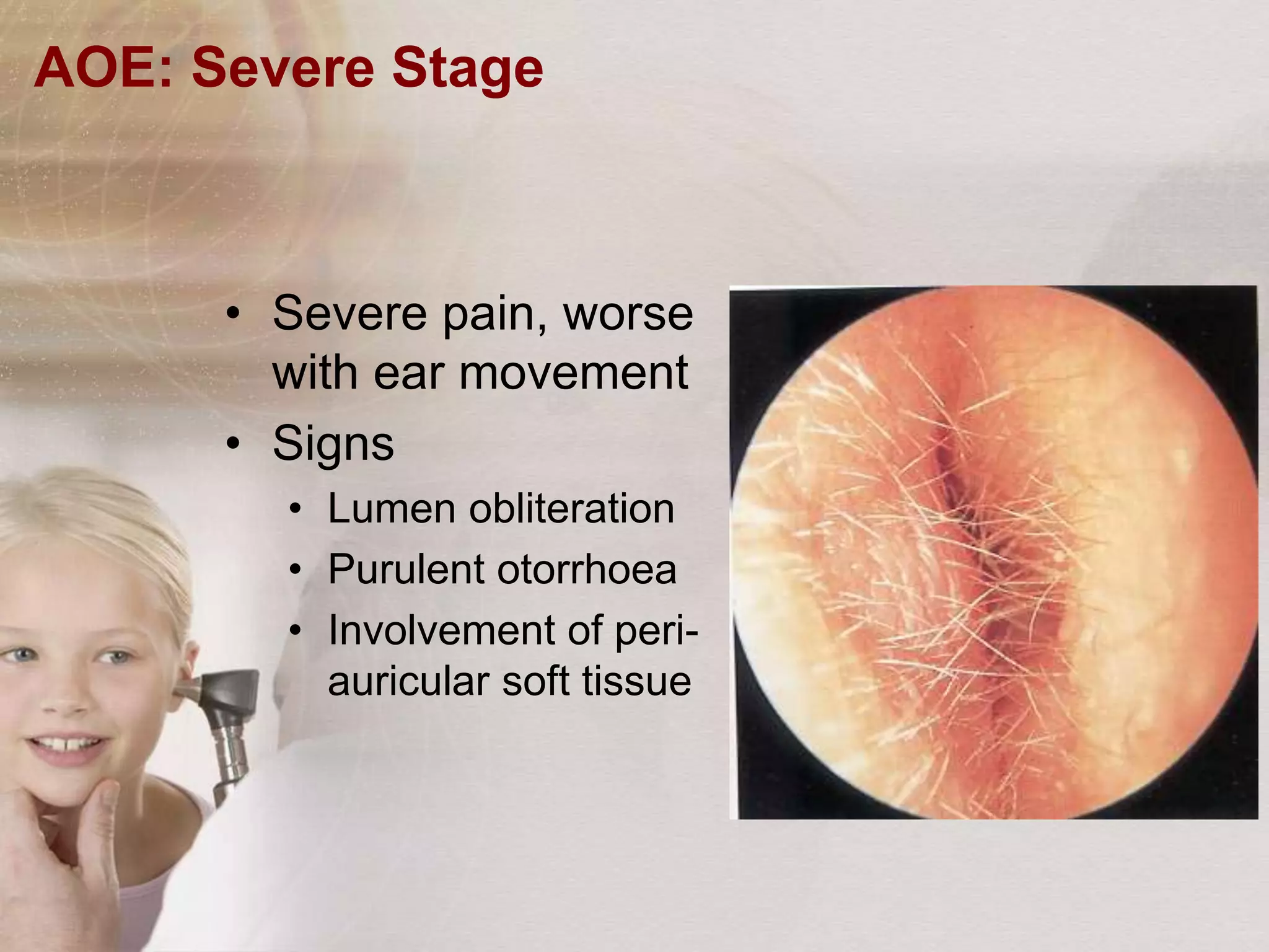 Otitis externa | PPTX