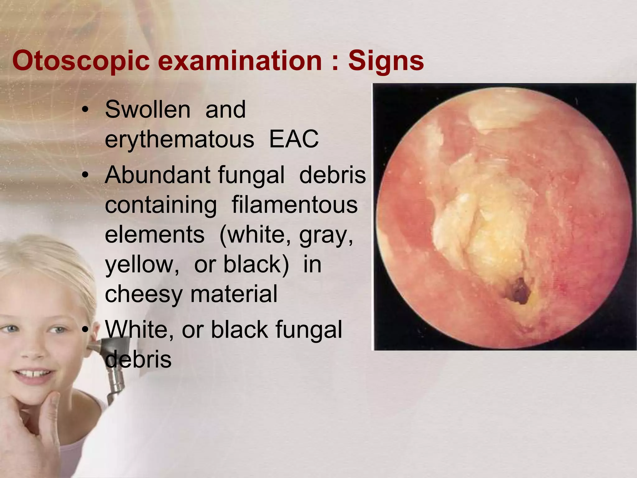 Otitis externa | PPTX