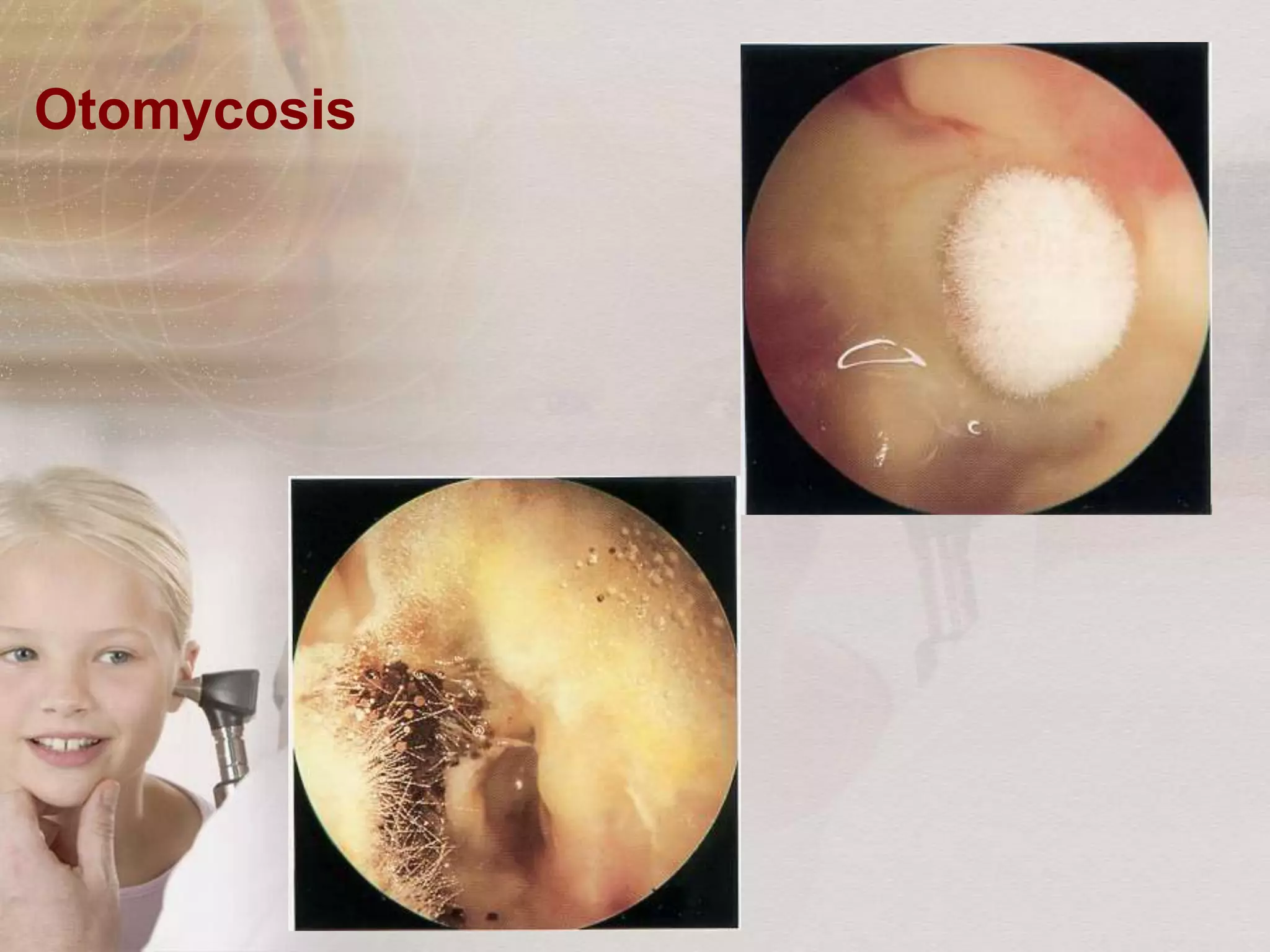 Otitis externa | PPTX