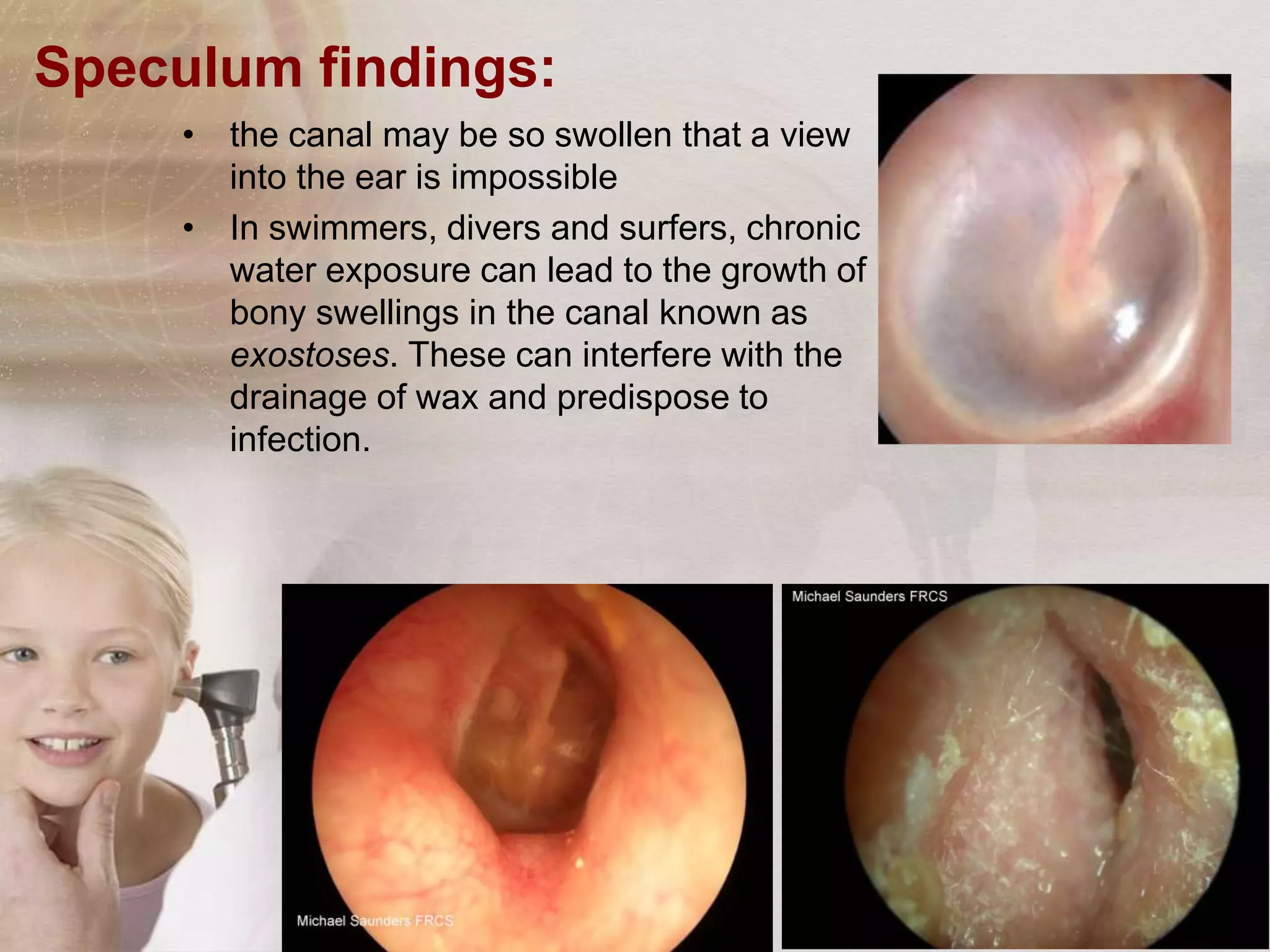 Otitis externa | PPTX