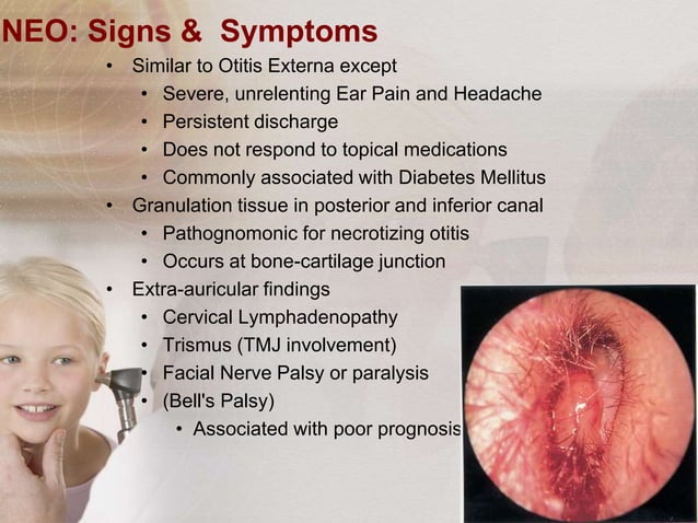 Otitis externa | PPTX