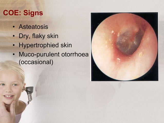Otitis externa