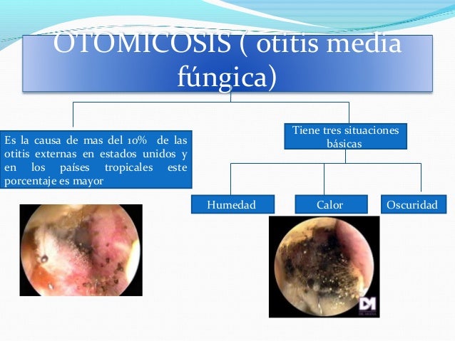 Otitis Externa OTL UCC-Santa Marta. Medicina