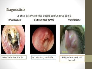 Otitis | PPTX