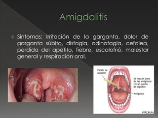 Otitis, faringitis y amigdalitis | PPTX