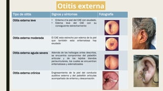 Otitis media y aguda presentacion L.F.R.pptx