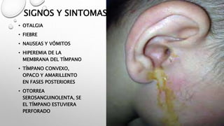 Otitis média crónica | PPTX