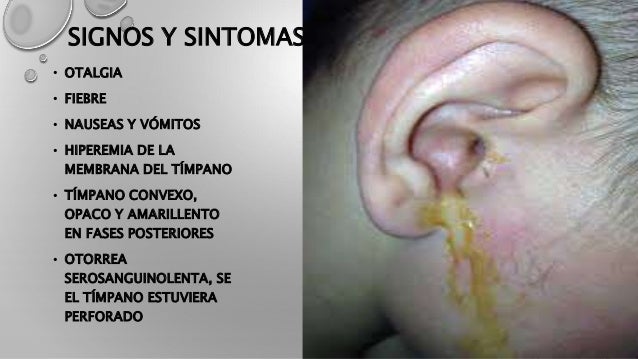 Otitis média crónica
