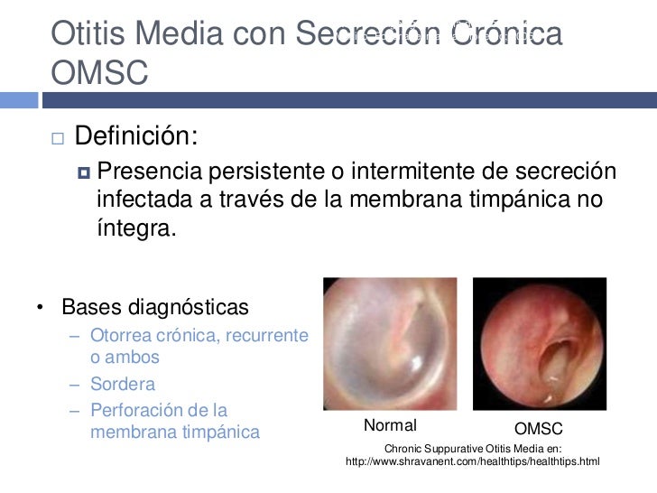 Otitis media