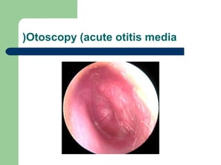 Otitis media | PPT