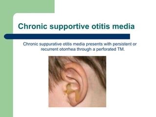 Otitis media | PPT