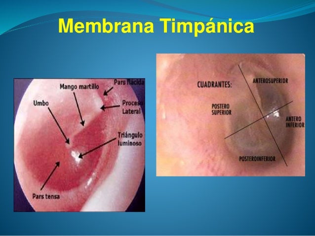 Derrame Da Membrana Timpanica