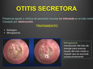 Otitis media | PPT