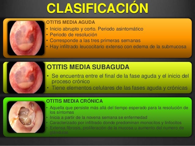 Otitis media