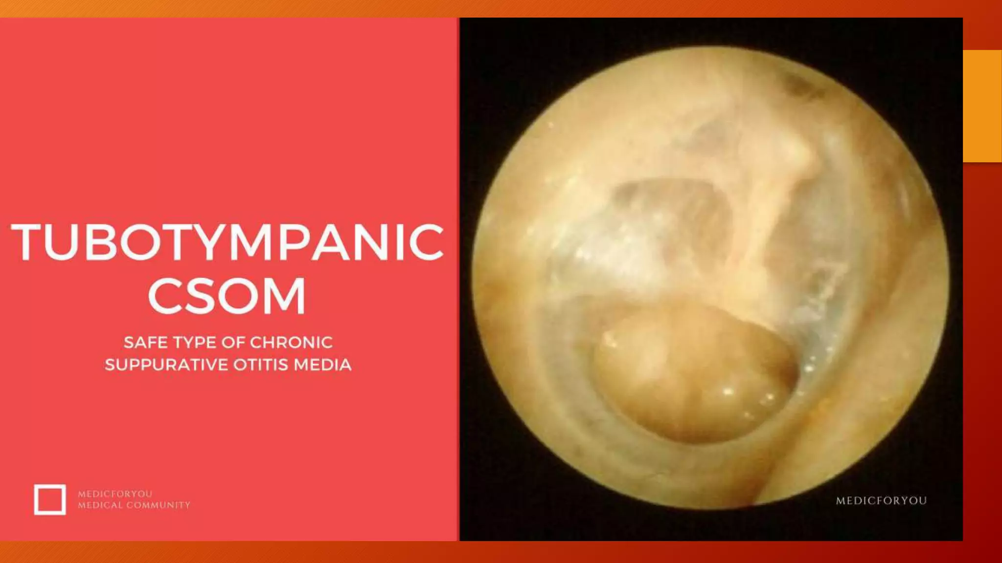 Otitis media ear infection ppt | PPTX