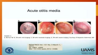 Otitis media ear infection ppt | PPTX